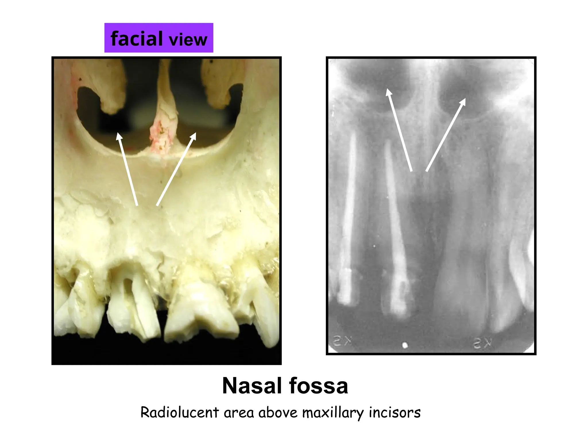 7 Normal Anatomical Landmarks OF MAXIILA AND MANDIBLE.ppt