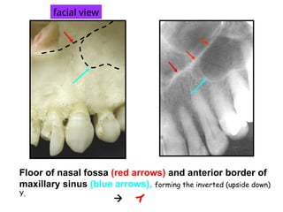 7 Normal Anatomical Landmarks OF MAXIILA AND MANDIBLE.ppt