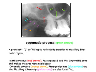 7 Normal Anatomical Landmarks OF MAXIILA AND MANDIBLE.ppt