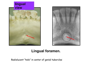 7 Normal Anatomical Landmarks OF MAXIILA AND MANDIBLE.ppt