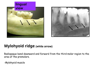 7 Normal Anatomical Landmarks OF MAXIILA AND MANDIBLE.ppt