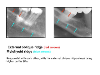 7 Normal Anatomical Landmarks OF MAXIILA AND MANDIBLE.ppt