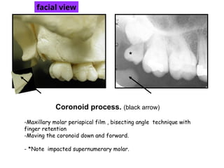 7 Normal Anatomical Landmarks OF MAXIILA AND MANDIBLE.ppt