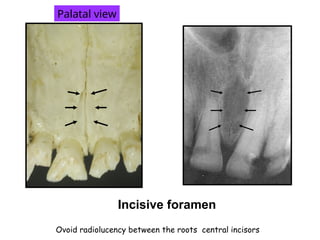 7 Normal Anatomical Landmarks OF MAXIILA AND MANDIBLE.ppt