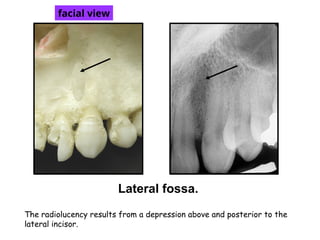 7 Normal Anatomical Landmarks OF MAXIILA AND MANDIBLE.ppt