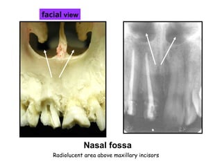 7 Normal Anatomical Landmarks OF MAXIILA AND MANDIBLE.ppt
