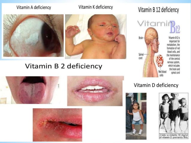 7 nutritional diseases | PPTX | Medical Health
