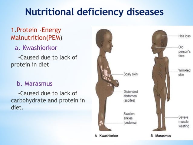 7 nutritional diseases | PPTX | Medical Health