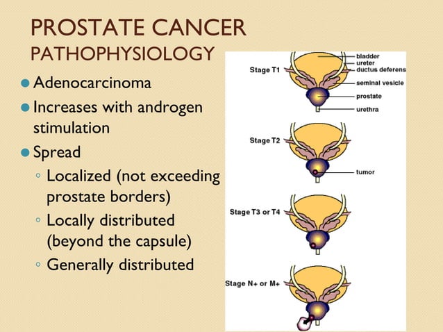 7 Oncourology.pptx | Cancer | Diseases and Conditions