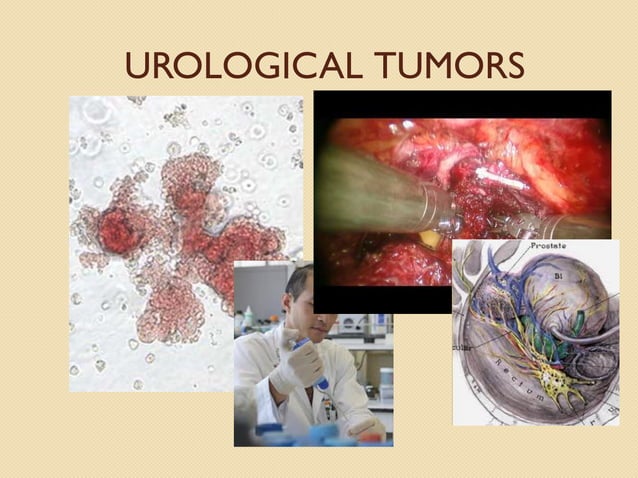 7 Oncourology.pdf, cancers in the male urinary system | PPT