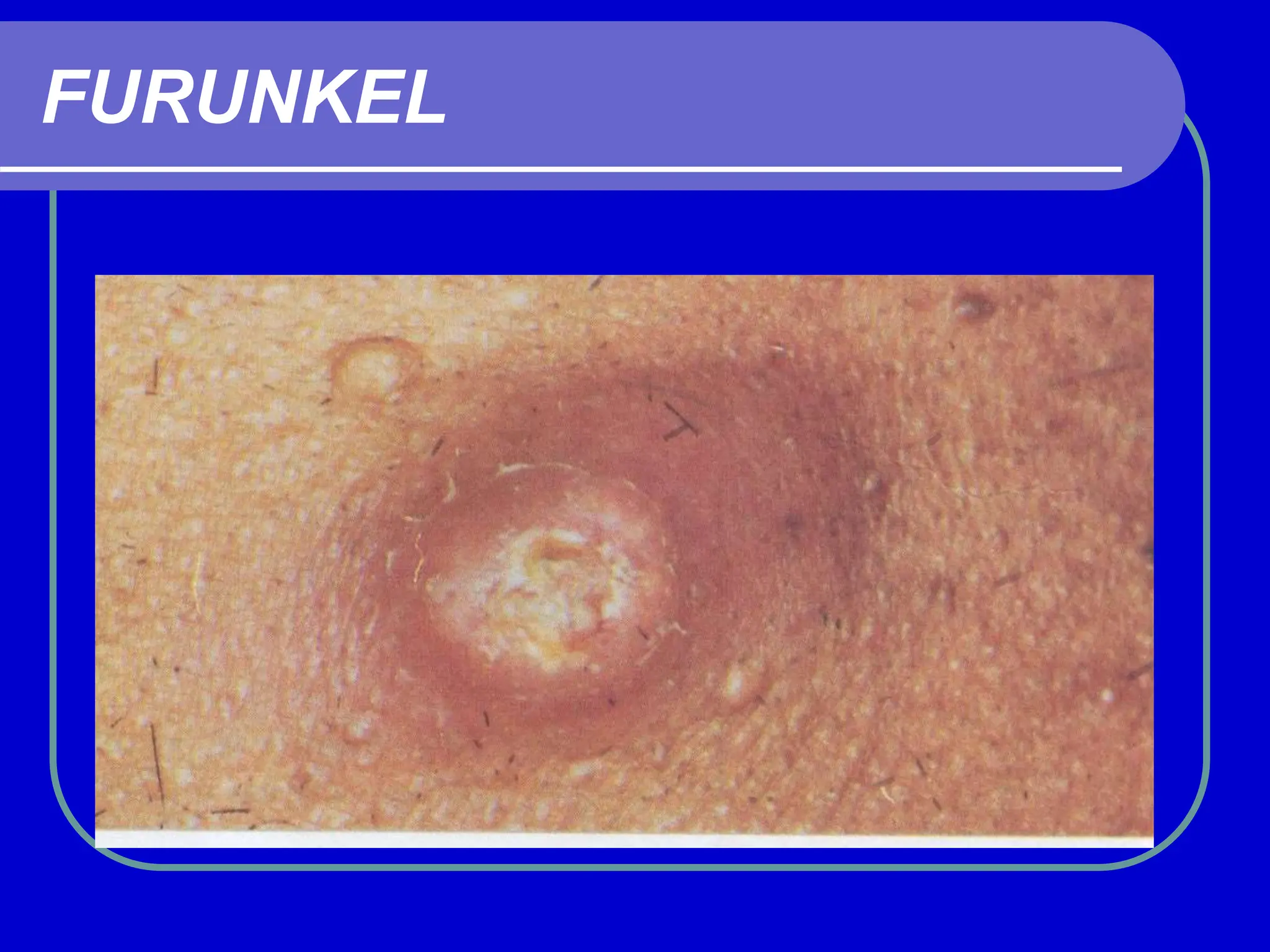 Penyakit kulit yang disebabkan oleh Bakteri (Pioderma) | PPT