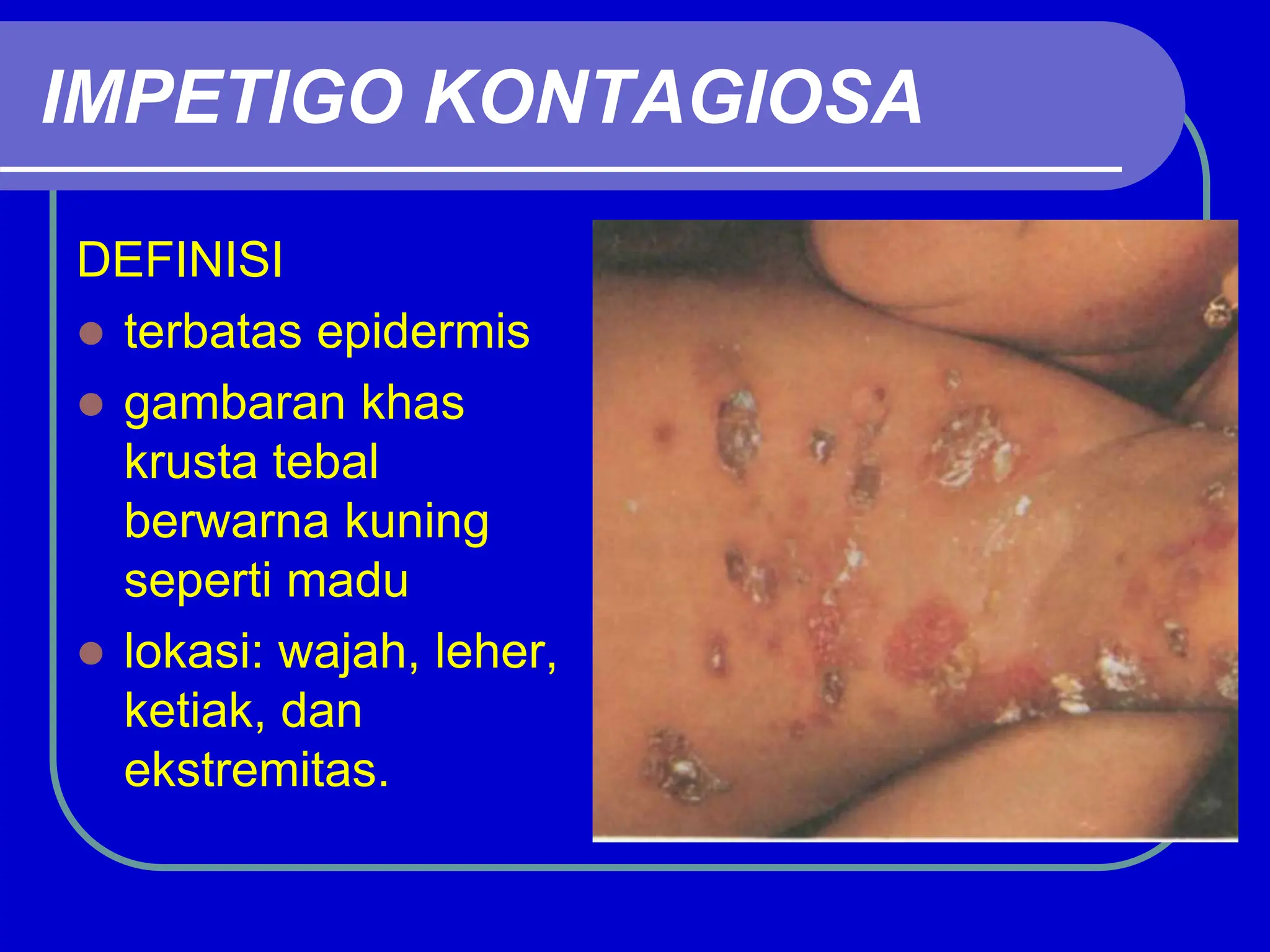Penyakit kulit yang disebabkan oleh Bakteri (Pioderma) | PPT