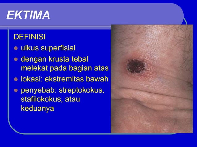 Penyakit kulit yang disebabkan oleh Bakteri (Pioderma) | PPT