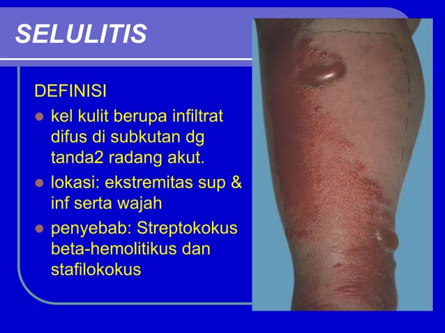 Penyakit kulit yang disebabkan oleh Bakteri (Pioderma) | PPT