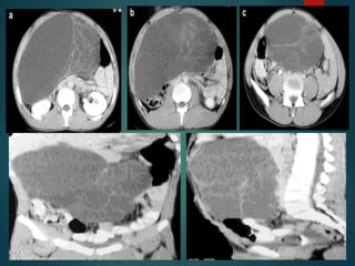 Peritoneum Anatomy and pathology part 2 | PPTX