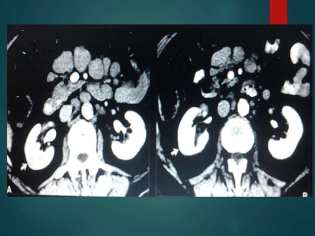 Peritoneum Anatomy and pathology part 2 | PPTX