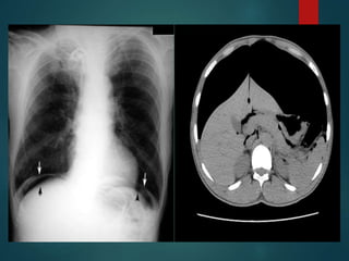 Peritoneum Anatomy and pathology part 2 | PPTX