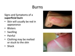 7 provide first aid burns | PPT