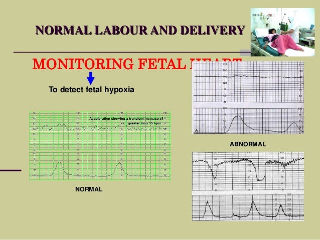 Normal labour and delivery