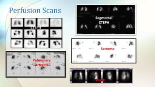CTEPH Diagnosis and Medical Treatment Update | PPTX