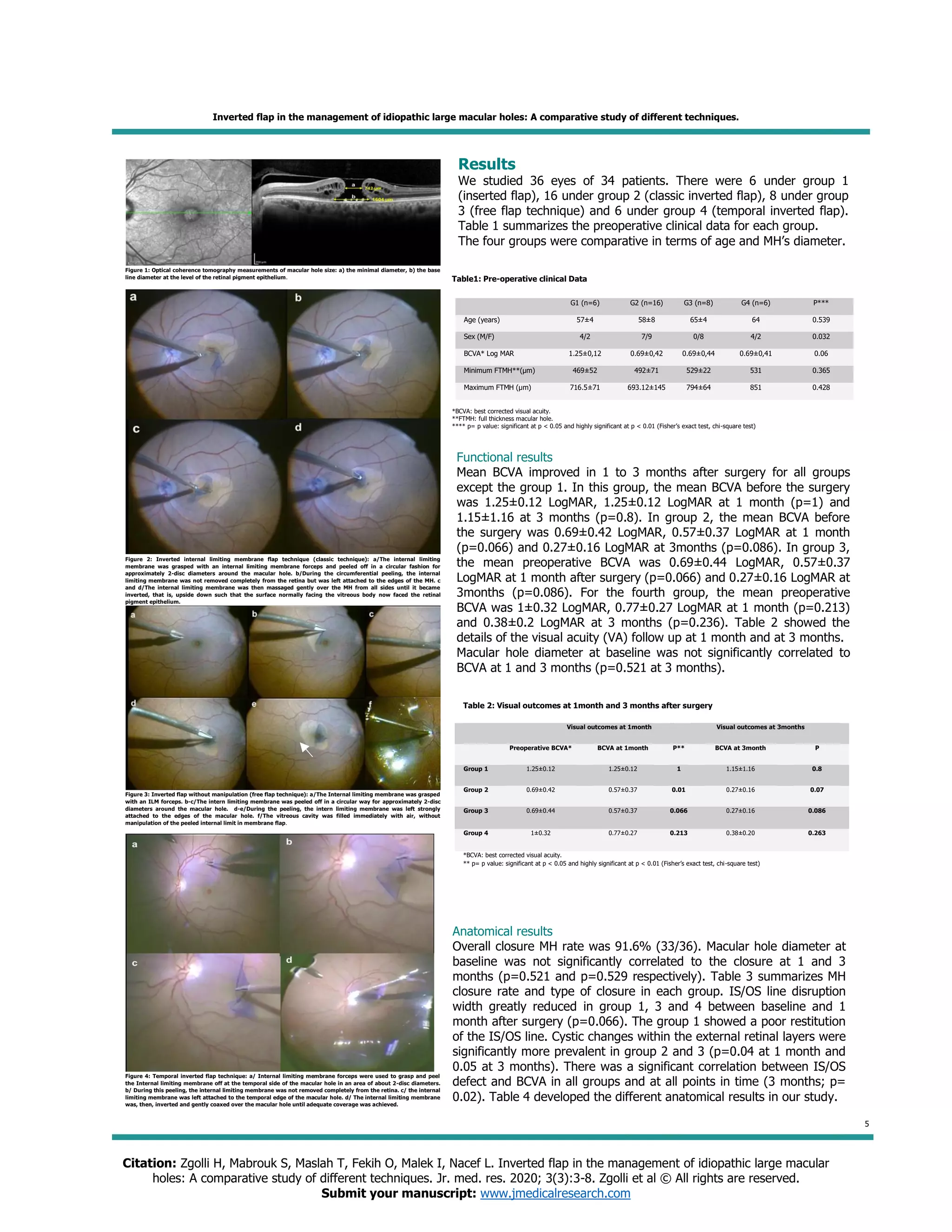 Macular hole surgeries | PDF