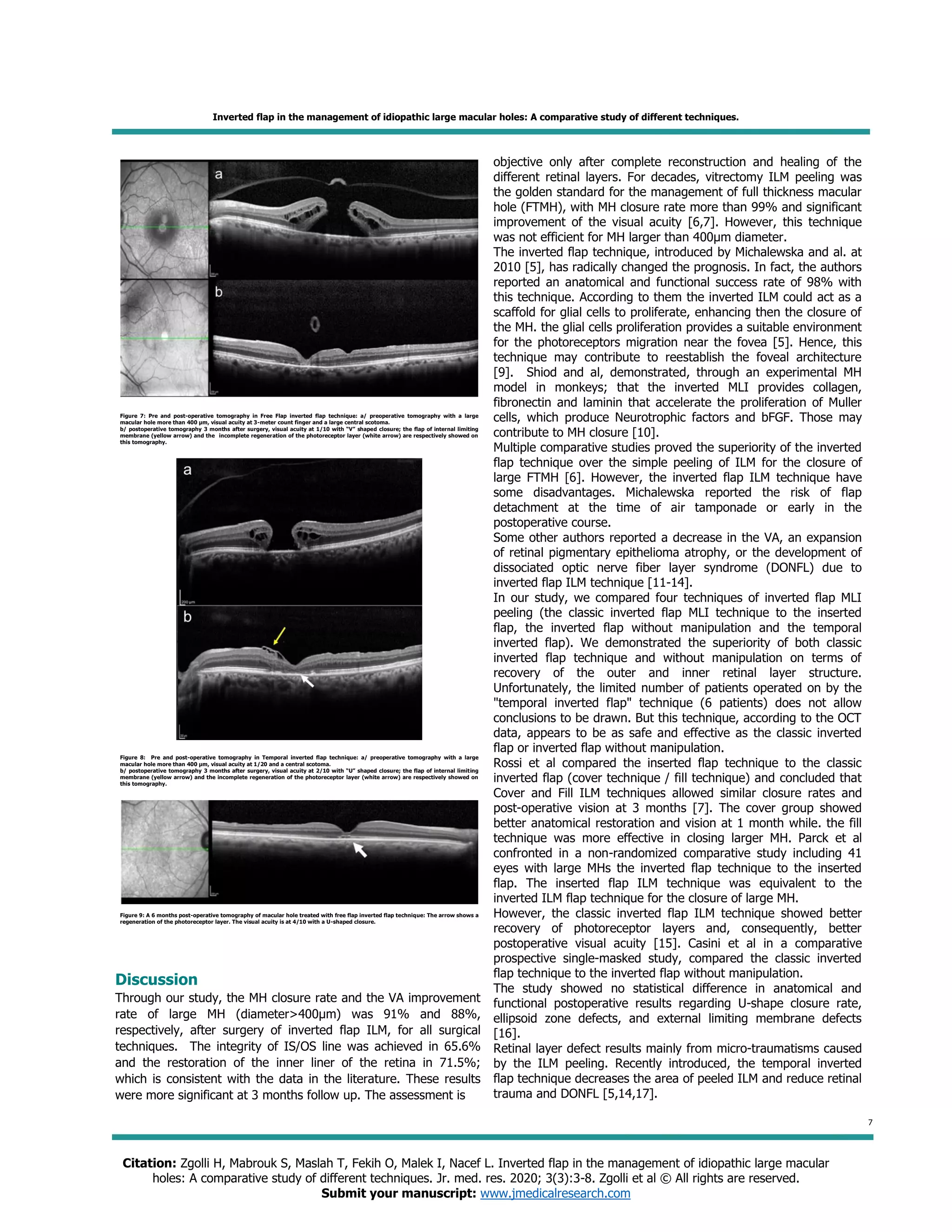 Macular hole surgeries | PDF