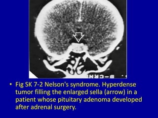 7 sellar and juxtasellar masses on computed tomography | PPTX
