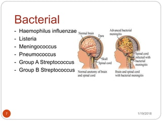 meningitis | PPTX