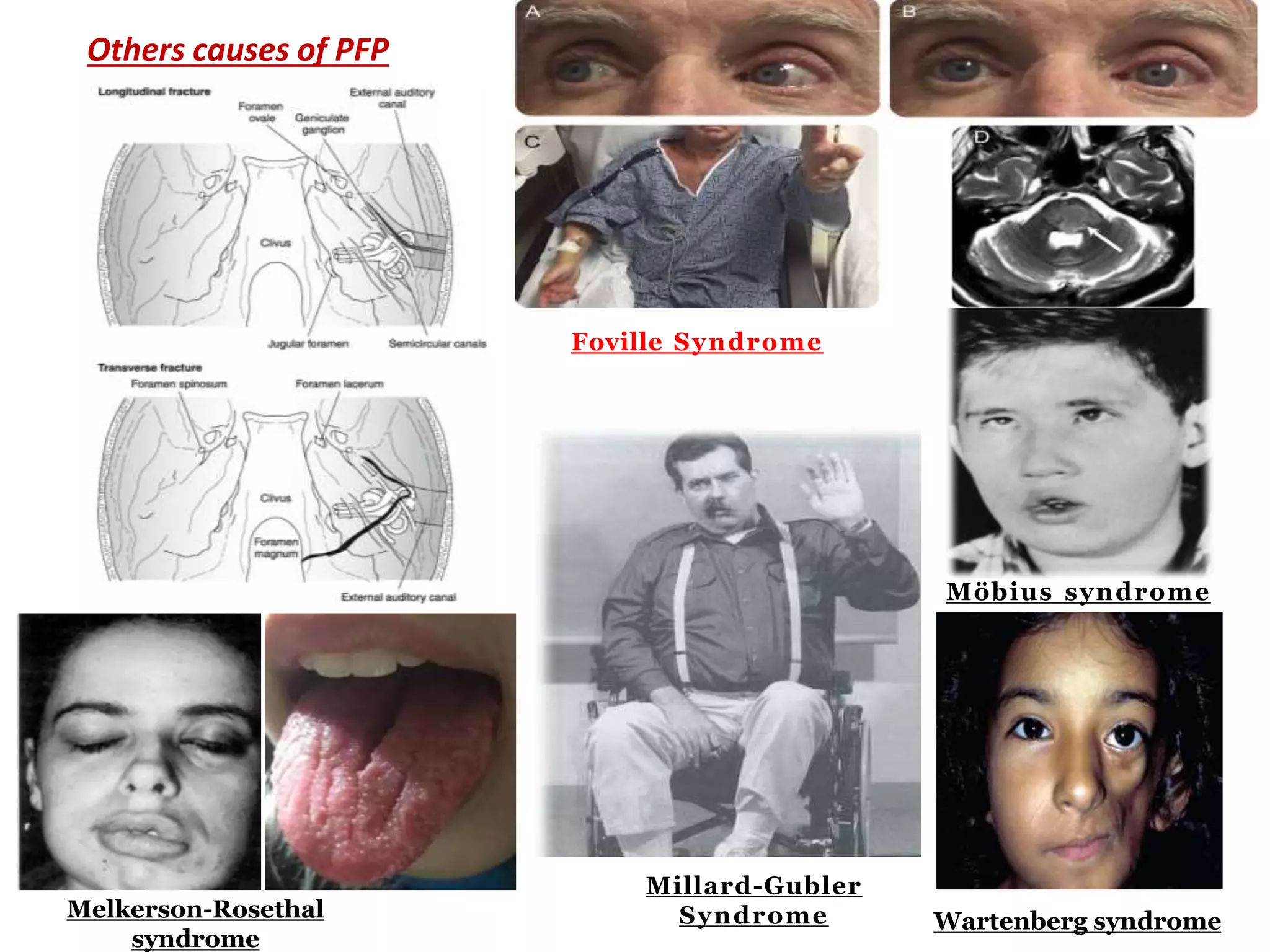 facial nerve examination | PPTX