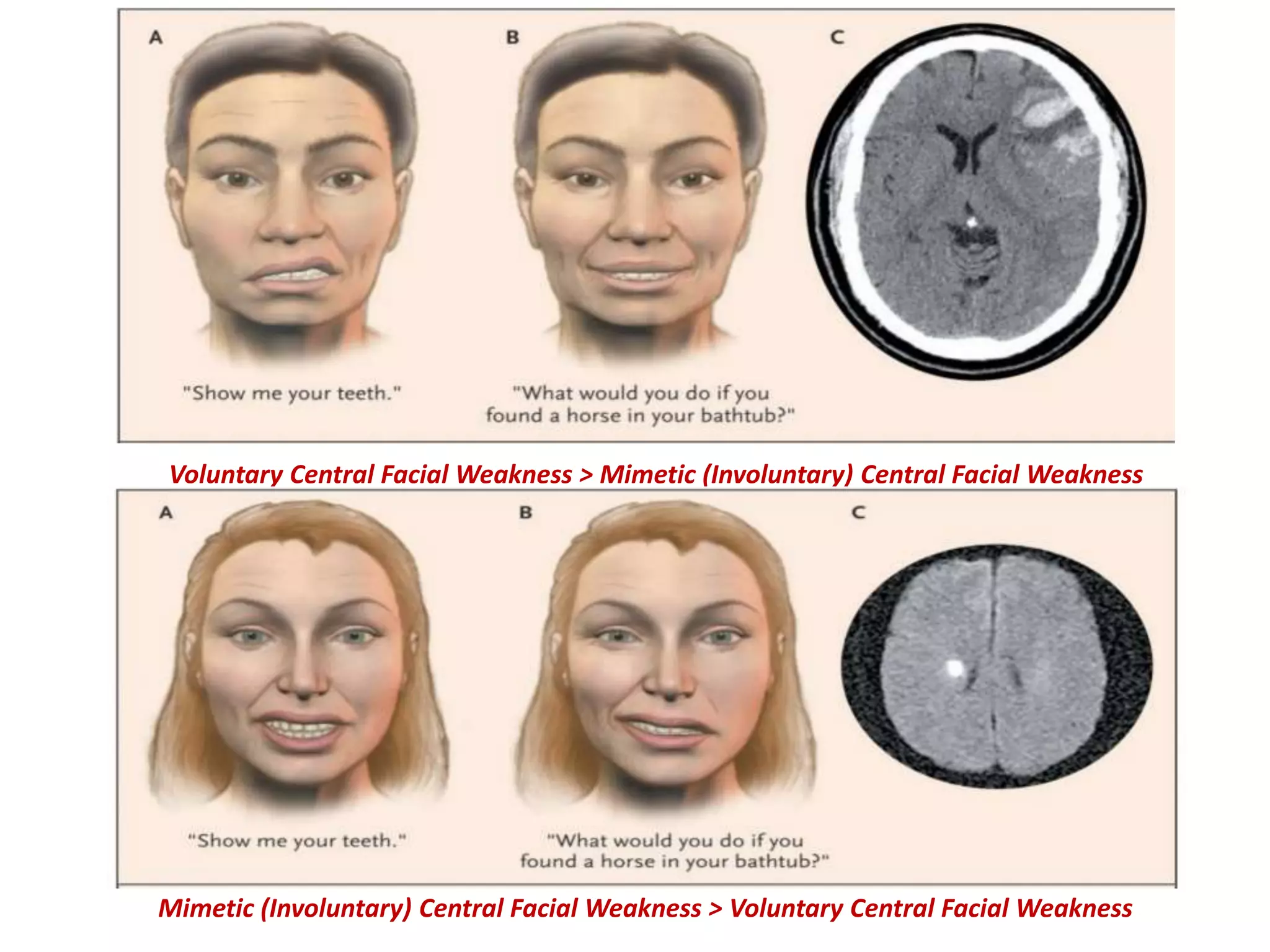 facial nerve examination | PPTX