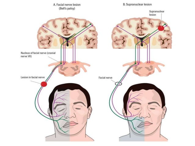 facial nerve examination | PPTX | Ear, Nose and Throat Conditions ...