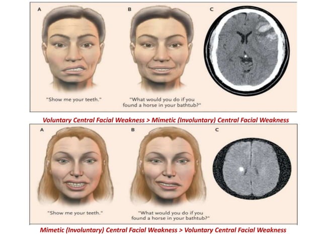 facial nerve examination | PPTX | Ear, Nose and Throat Conditions ...