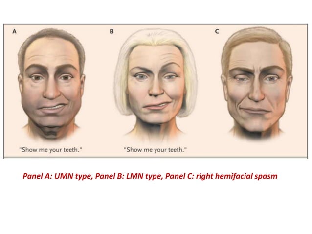 facial nerve examination | PPTX | Ear, Nose and Throat Conditions ...