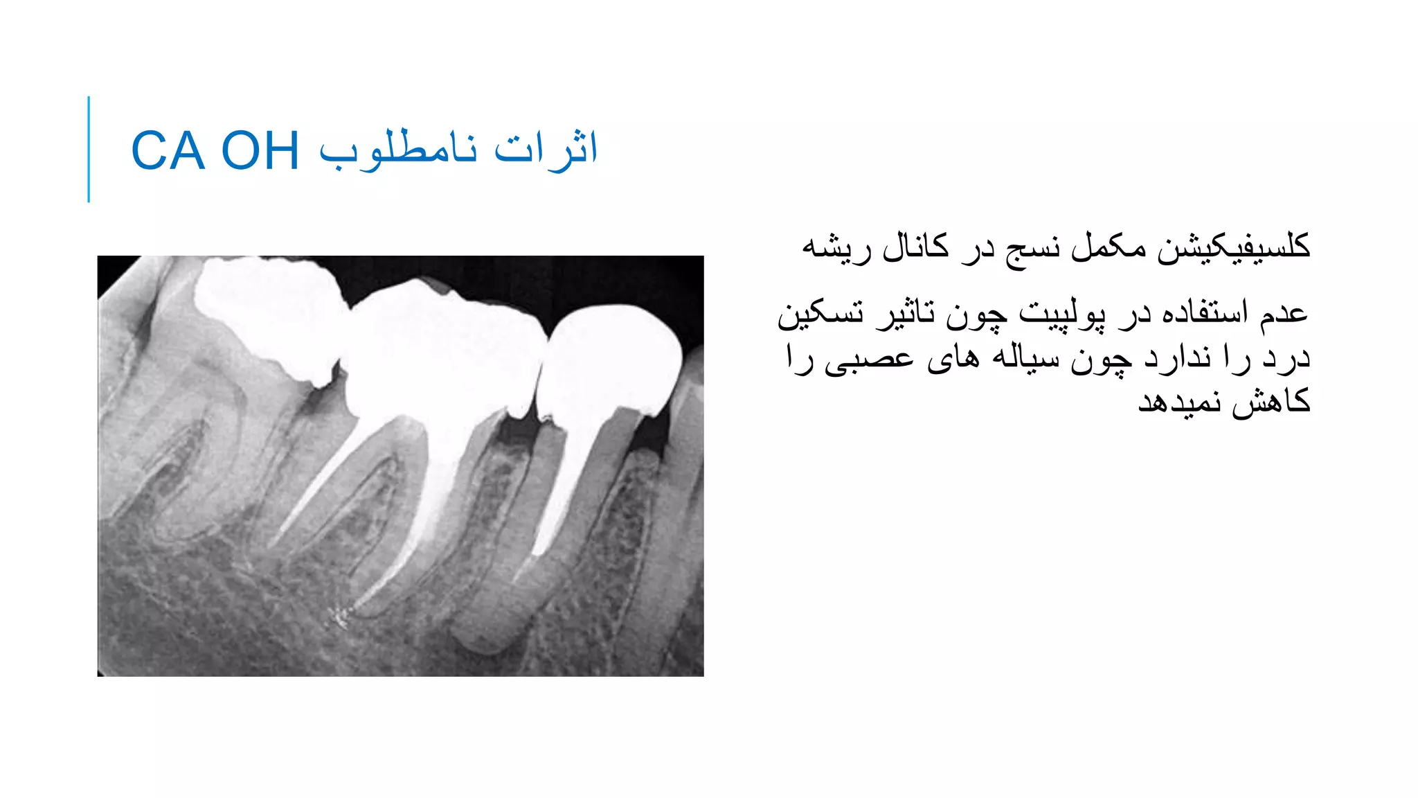 Pulp cap پولپ کاپ7th Lectures 7th.pptx