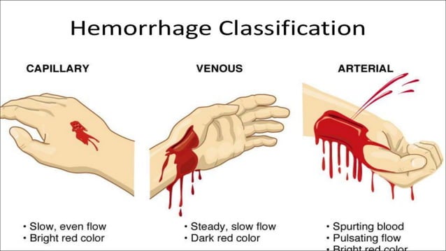 Controlling external bleeding | PDF