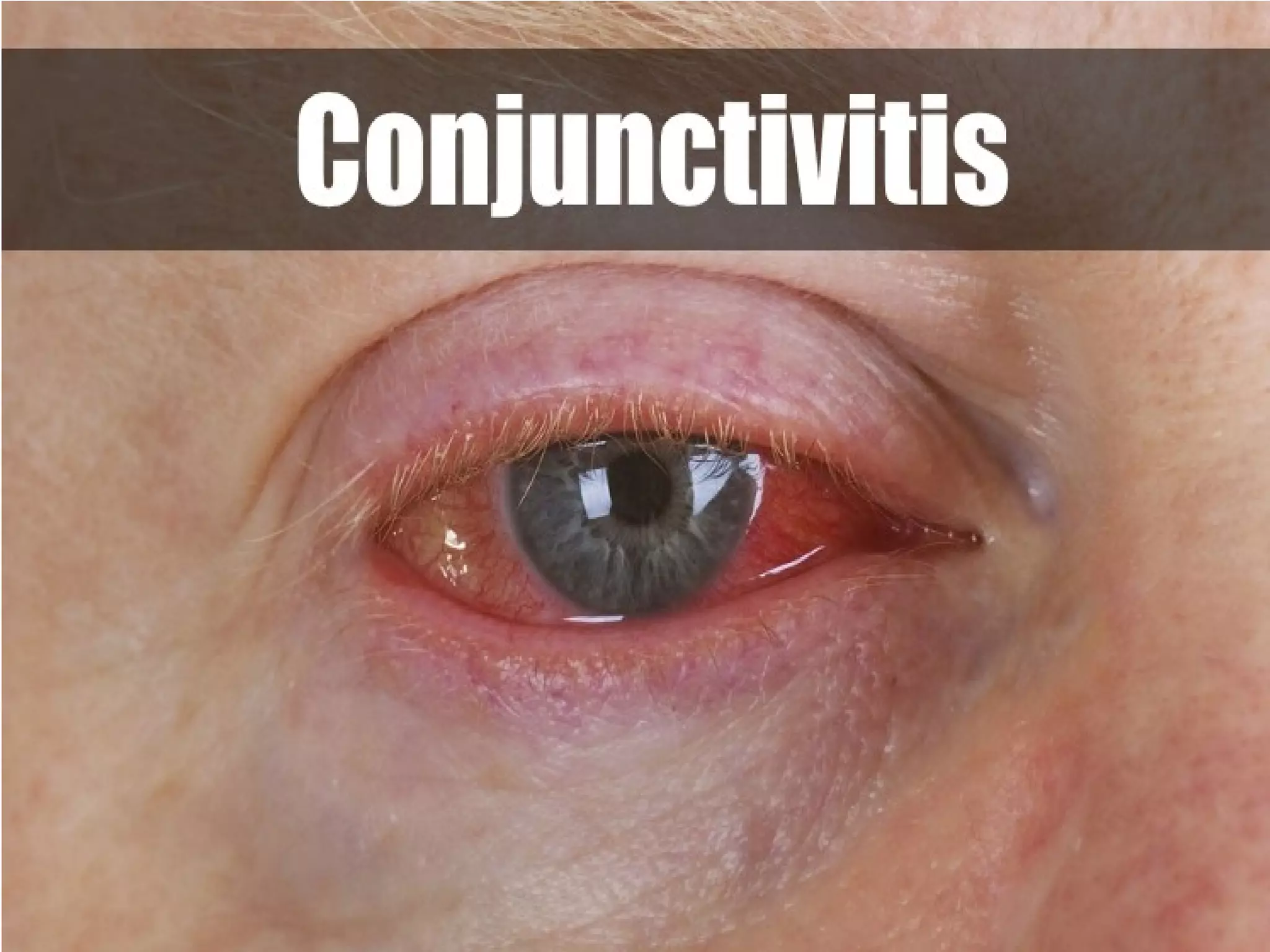 7 types of common eyes infections | PPT