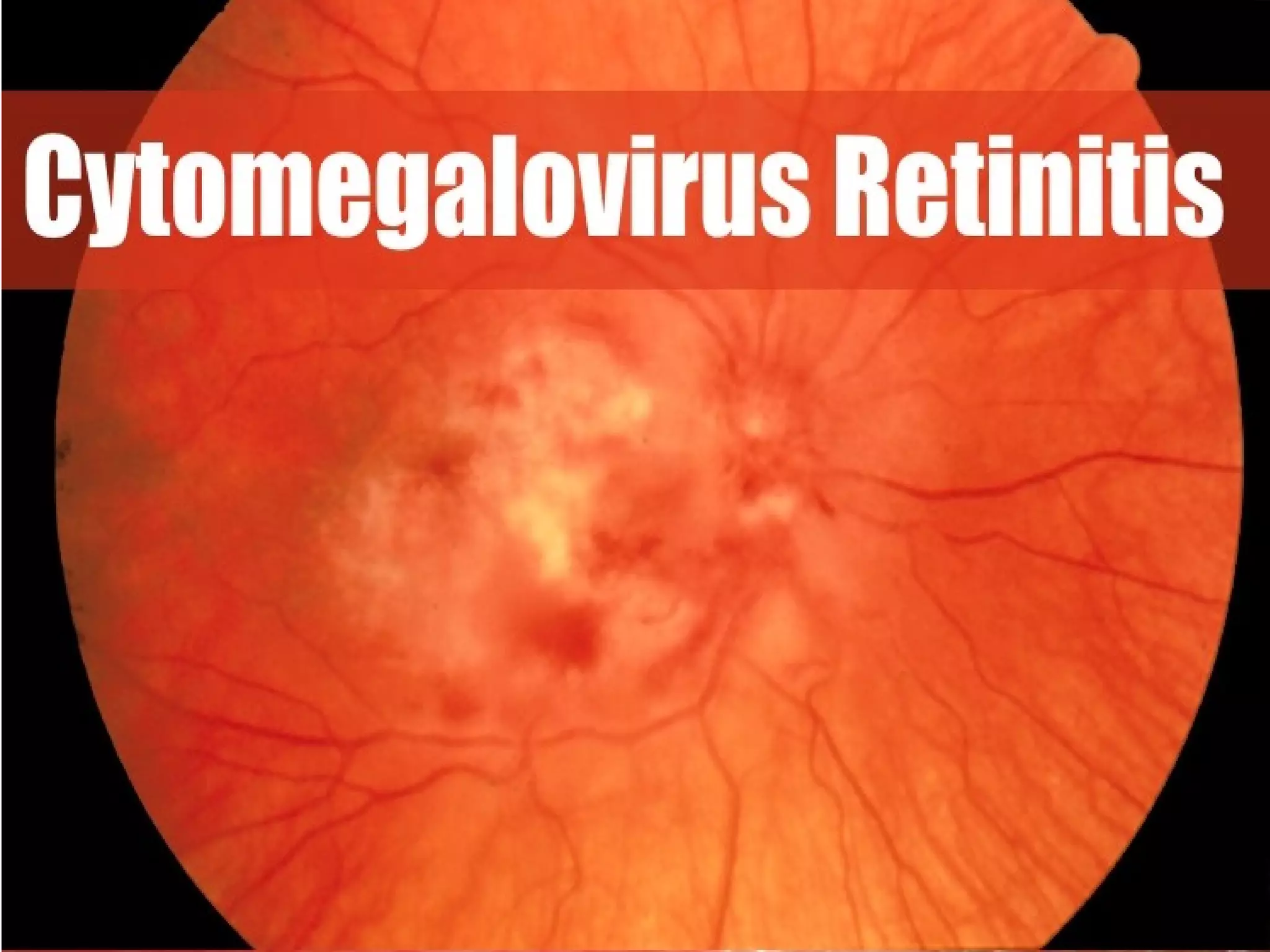 7 types of common eyes infections | PPT