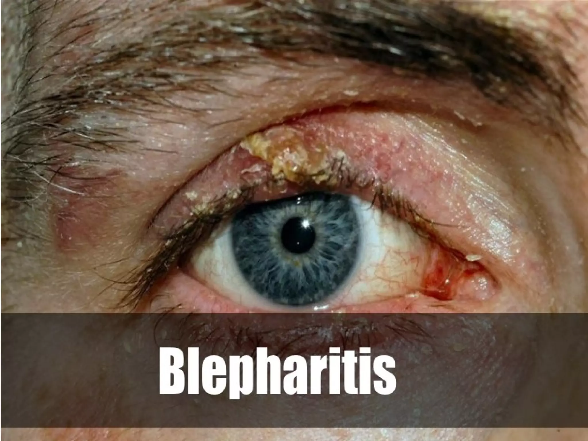 7 types of common eyes infections | PPT