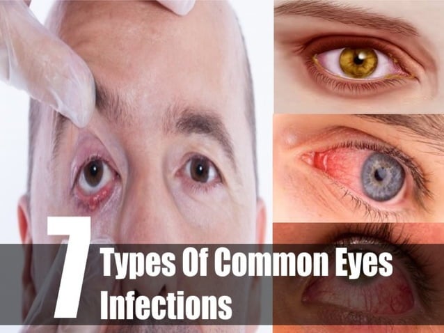 7 types of common eyes infections | PPT