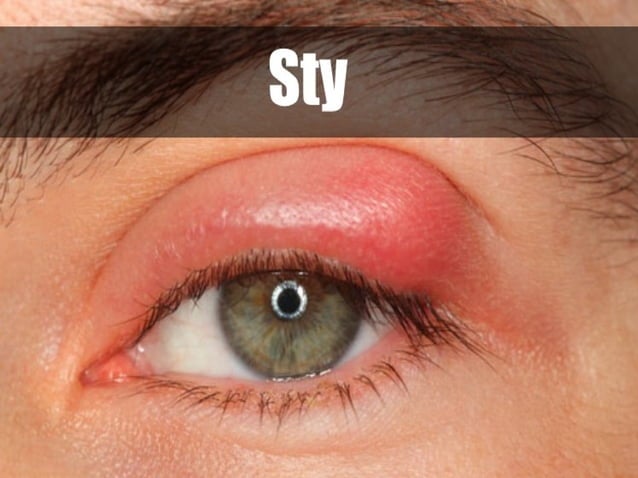 7 types of common eyes infections | PPT