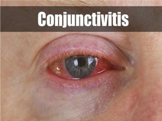 7 types of common eyes infections | PPT