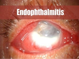 7 types of common eyes infections | PPT