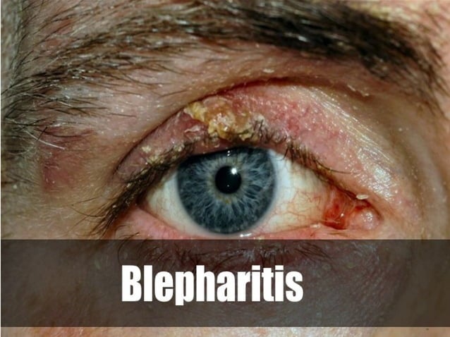 7 types of common eyes infections | PPT