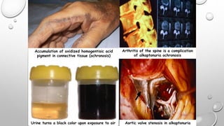 Disease related to aminoacid metabolosm | PPT