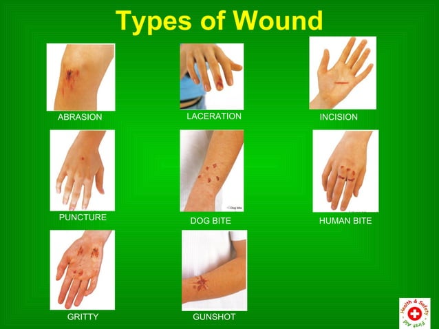 7 wounds and bleeding | PPT