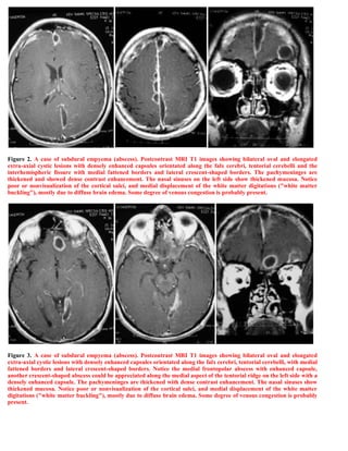 Case record...Subdural empyema | PDF