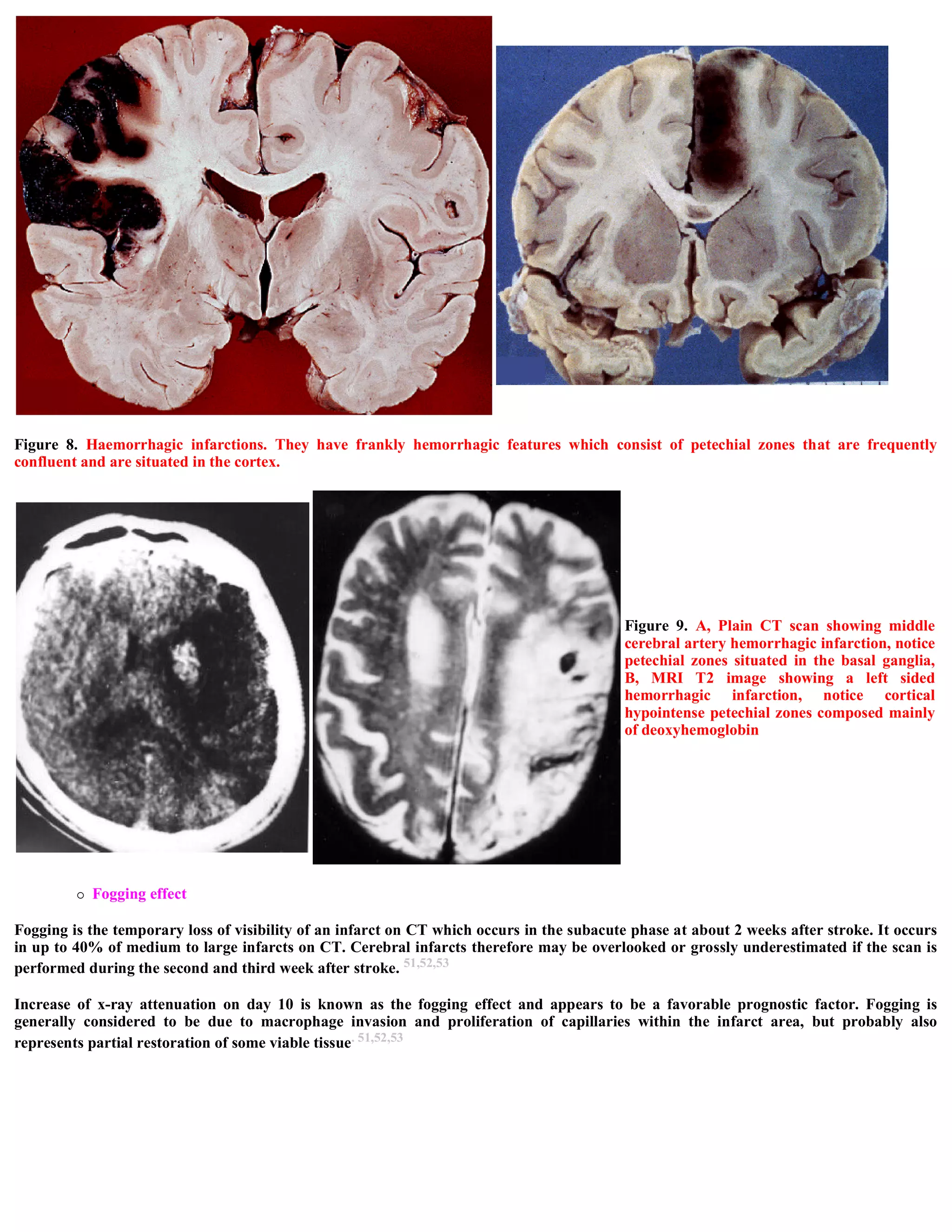 Topic of the month...Neuroimaging of embolic cerebral infarctions | PDF