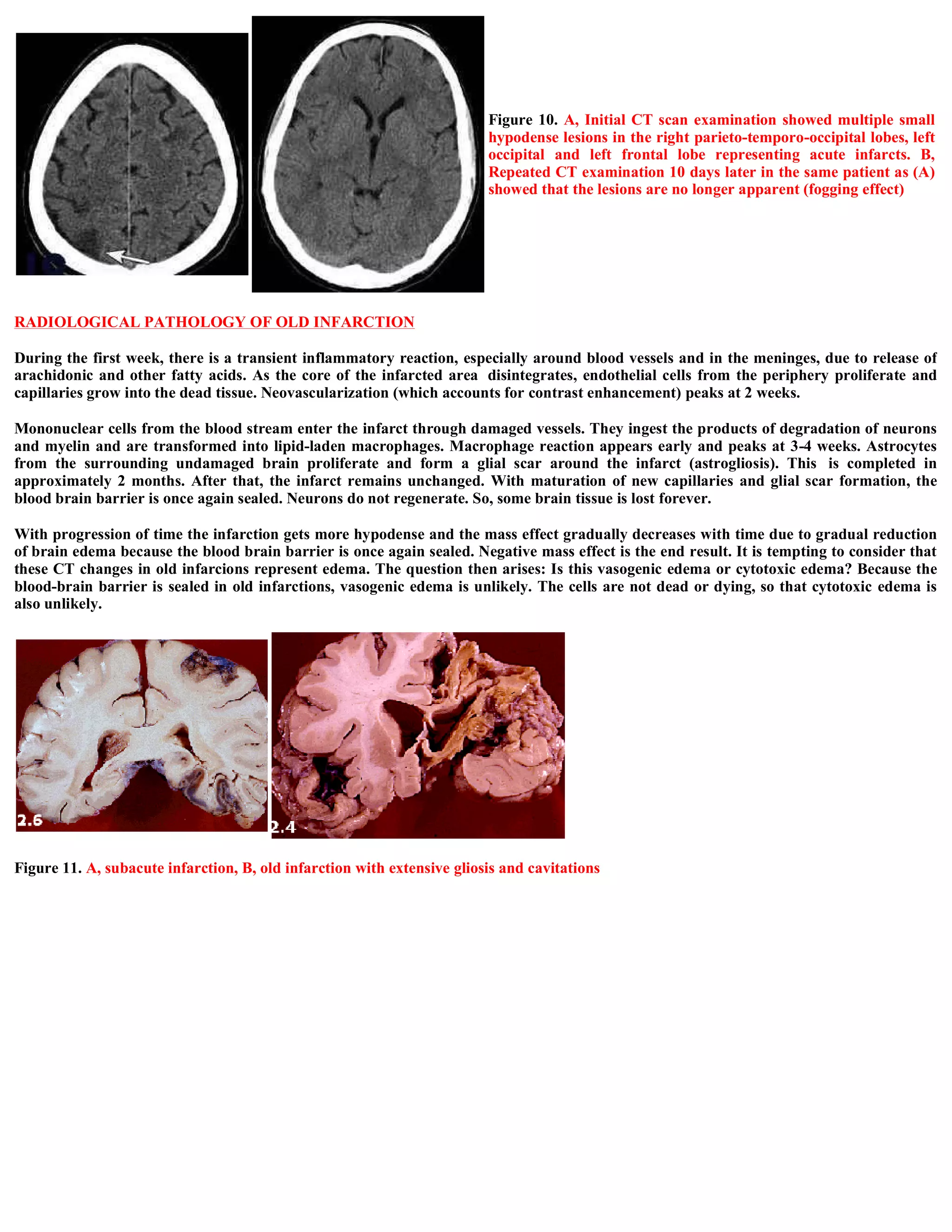 Topic of the month...Neuroimaging of embolic cerebral infarctions | PDF