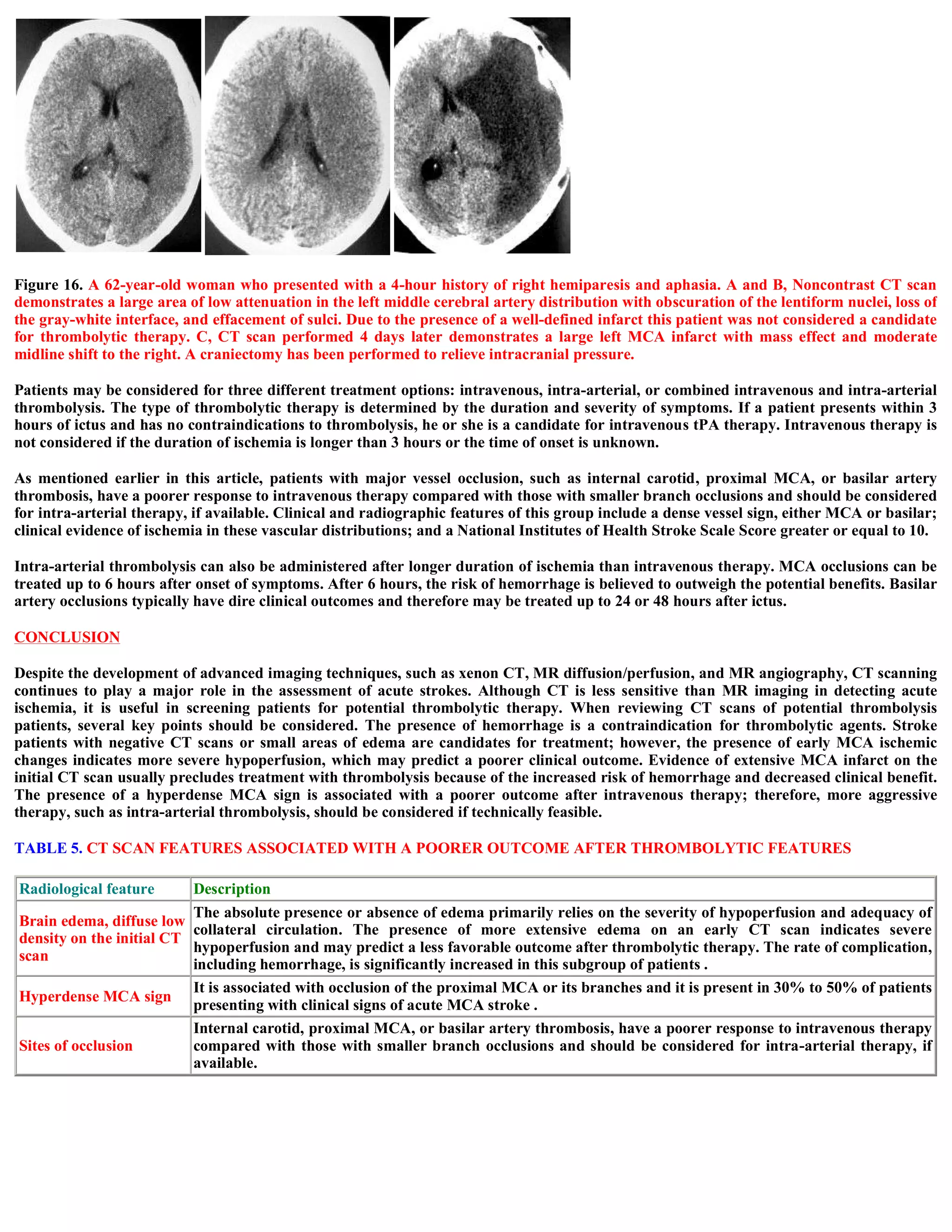 Topic of the month...Neuroimaging of embolic cerebral infarctions | PDF