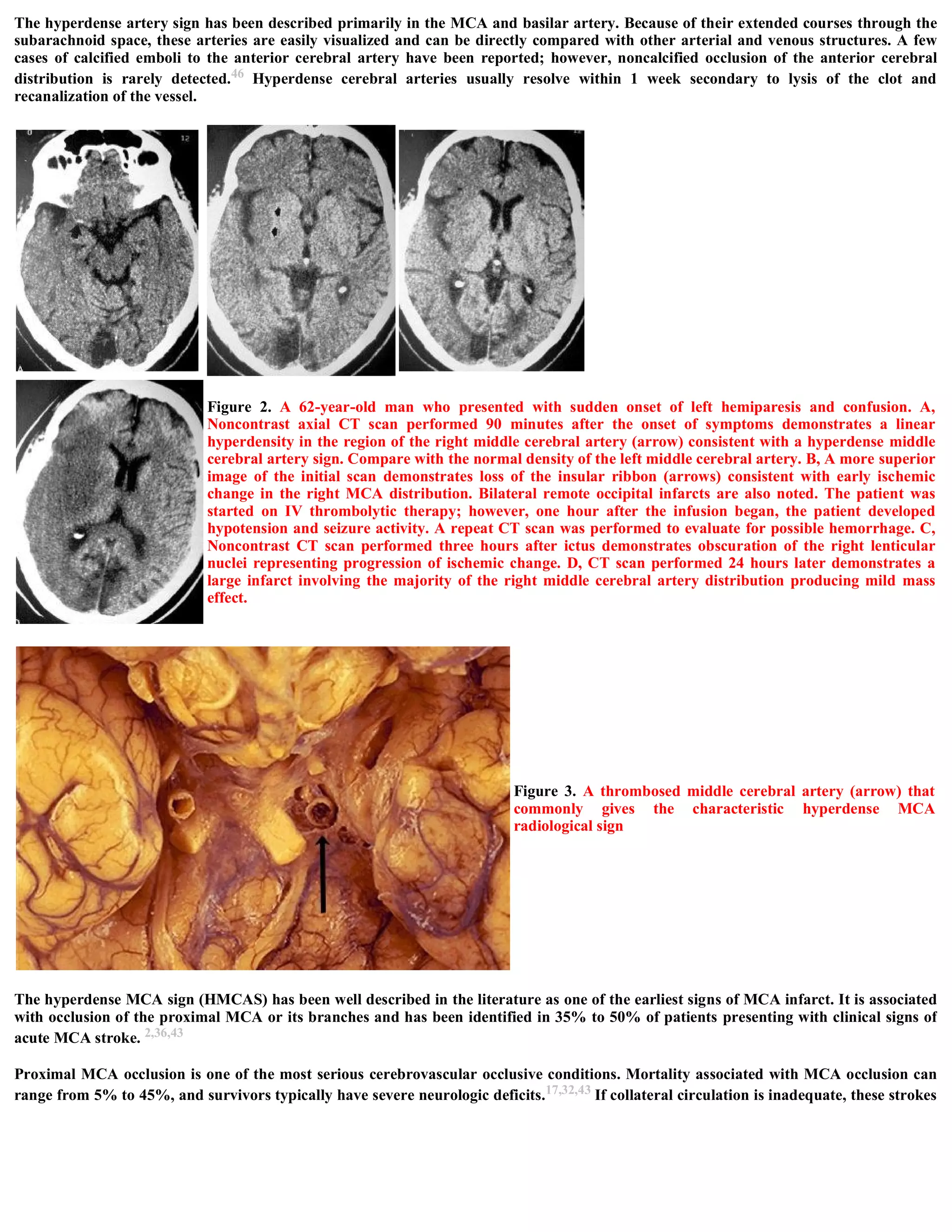 Topic of the month...Neuroimaging of embolic cerebral infarctions | PDF